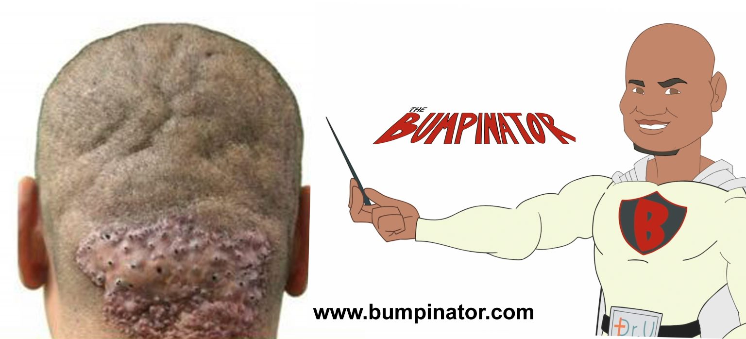 Your Barber Didn’t Do You Dirty – It Could Be Acne Kelodailis Nuchae ...