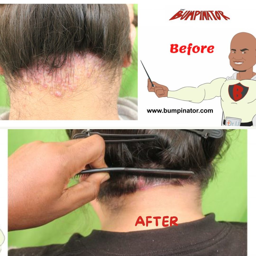 Video: 12-years Later, Man No Longer Suffers Bumps on Back Of His Head
