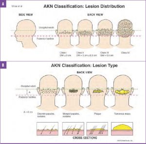 Acne Keloidalis Nuchae Surgical Laser Removal Before and After Picture ...
