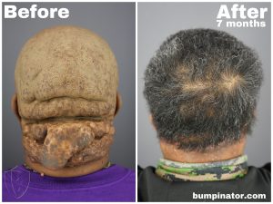 Acne Keloidalis Nuchae Surgical Laser Removal Before and After Picture ...