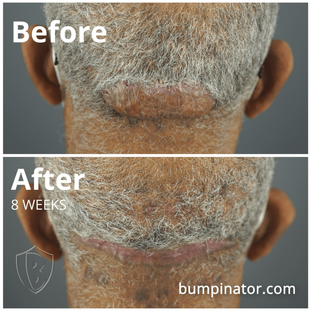 VIDEO: Large AKN Bump Removal, Before & After AKN Surgery Results