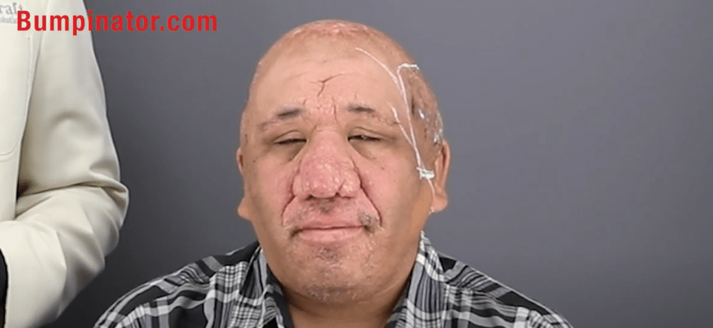 VIDEO: Severe AKN Removal True Story - AKN Recovery pt.2