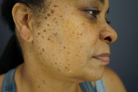 What is a Skin Tag or Dermatosis Papulosa Nigra (DPN)? - Bumpinator