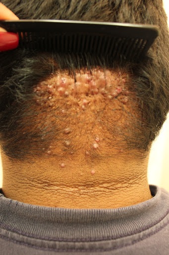 6 Bumps Redditors Think They Have But It Could Be AKN Instead – Bumpinator