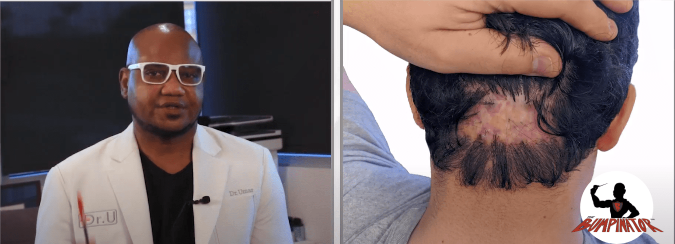 Military Shaved Head Requirements and Acne Keloidalis Nuchae