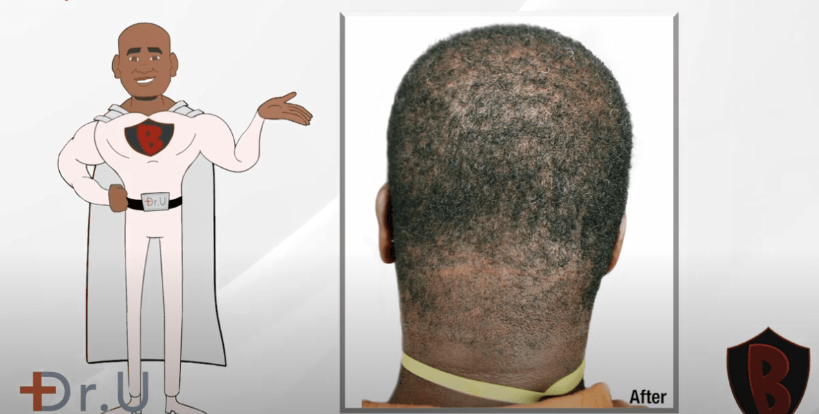 Acne Keloidalis Nuchae Removal With No Visible Scar 14 Years Later