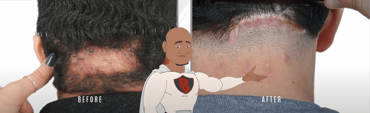 Military Shaved Head Requirements and Acne Keloidalis Nuchae