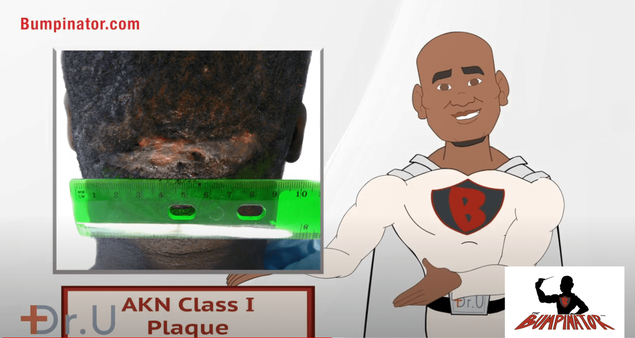 Acne Keloidalis Nuchae Removal With No Visible Scar 14 Years Later