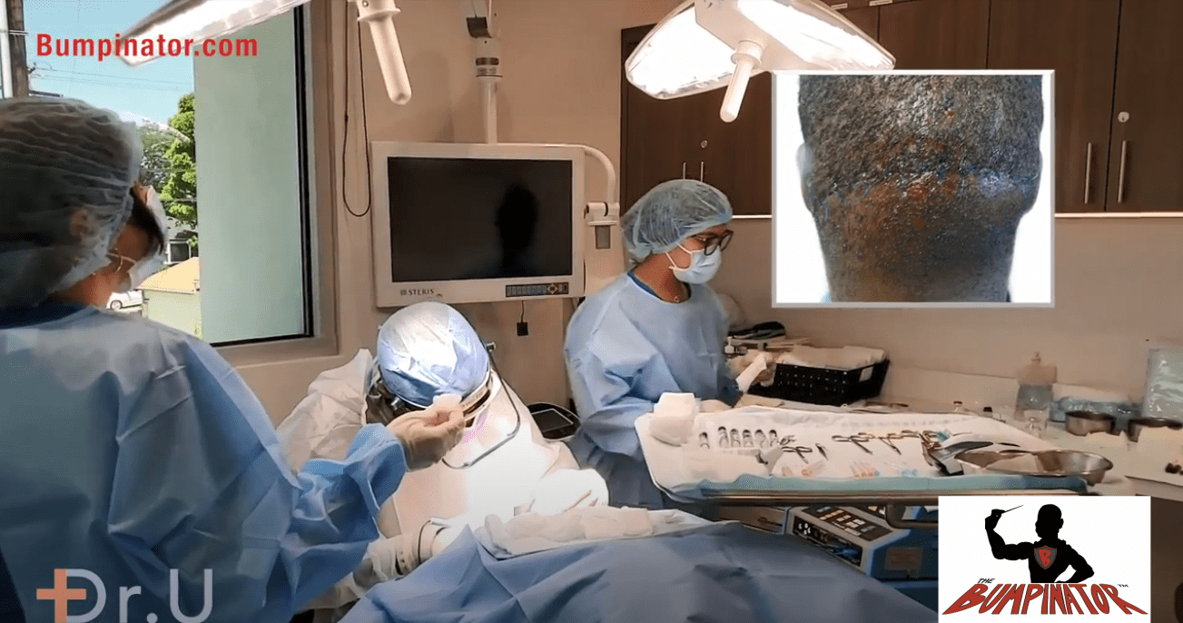 Acne Keloidalis Nuchae Removal With No Visible Scar 14 Years Later